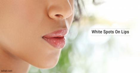 What Causes White Spots On The Lips - Infoupdate.org